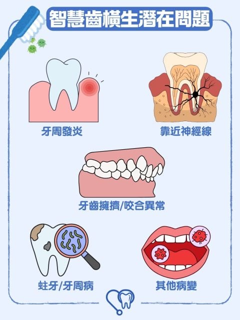 智慧齒橫生怎麼辦？會導致蛀牙或發炎嗎？一文解析5大潛在口腔問題與剝智慧齒手術流程